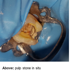 Pulp Stones - friend or foe?